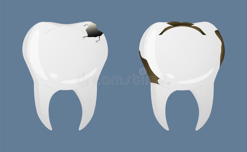 Teeth in Realistic Style. Teeth Decay Icons Stock Vector - Illustration ...