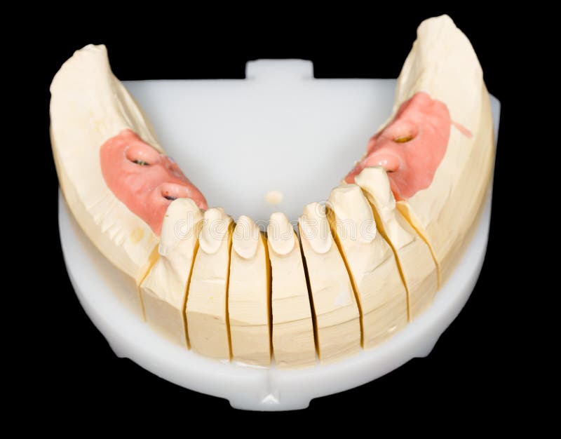 Teeth stump and implants stock image. Image of premolar - 94577121