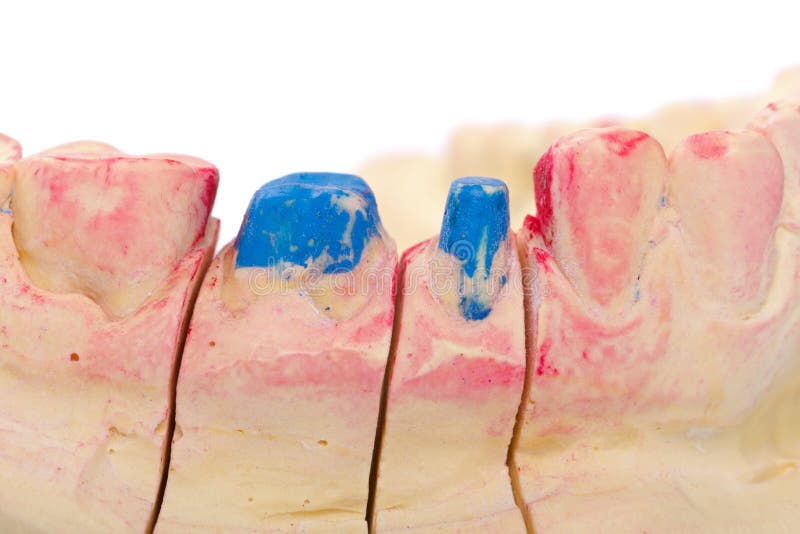 Teeth rehabilitation stock photo. Image of dentistry - 34213526