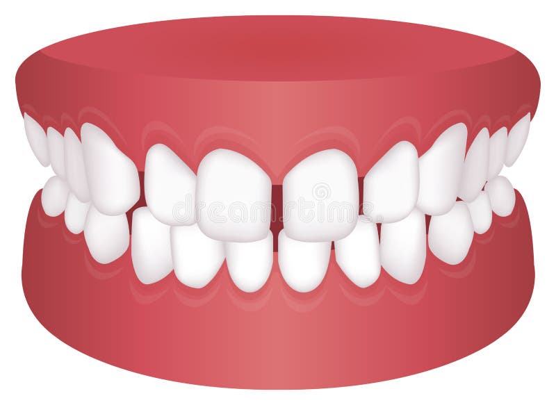 Teeth Trouble Bite Type Vector Illustration /Excessive Spacing Stock ...