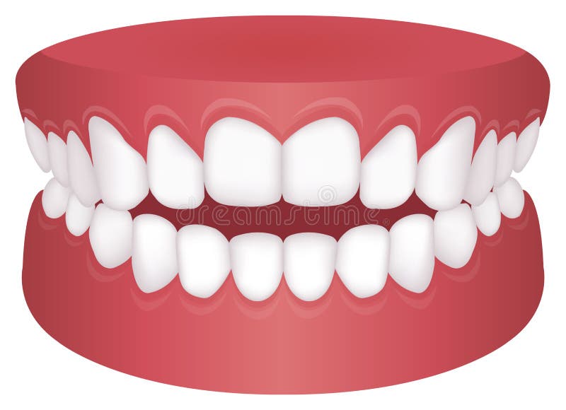 Teeth Trouble Bite Type Vector Illustration /Open Bite Stock Vector ...