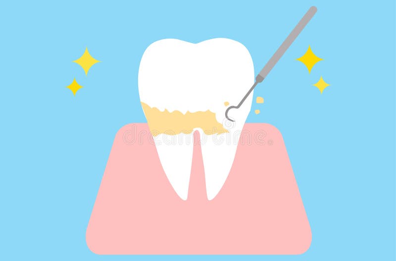 Teeth Undergoing Plaque Removal and Scaling Stock Vector - Illustration ...