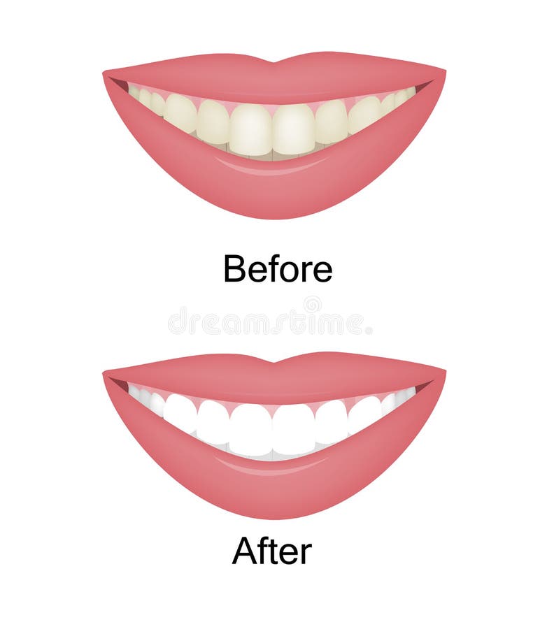 Teeth Whitening before and after. Vector Illustartion Stock Vector ...