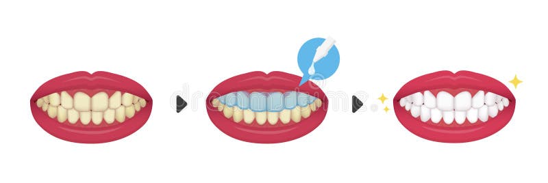 Teeth Whitening Vector Illustration / before and after No Text Stock ...
