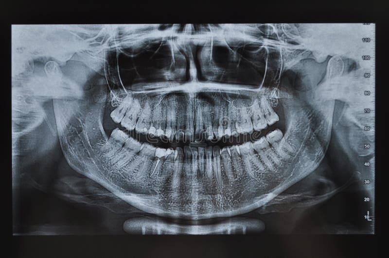 Teeth xray of full face stock image. Image of human - 213319619