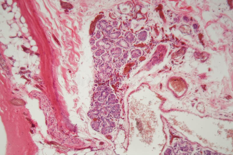 Tejido Pulmonar Humano Con Embolia Pulmonar Debajo De Un Microscopio ...