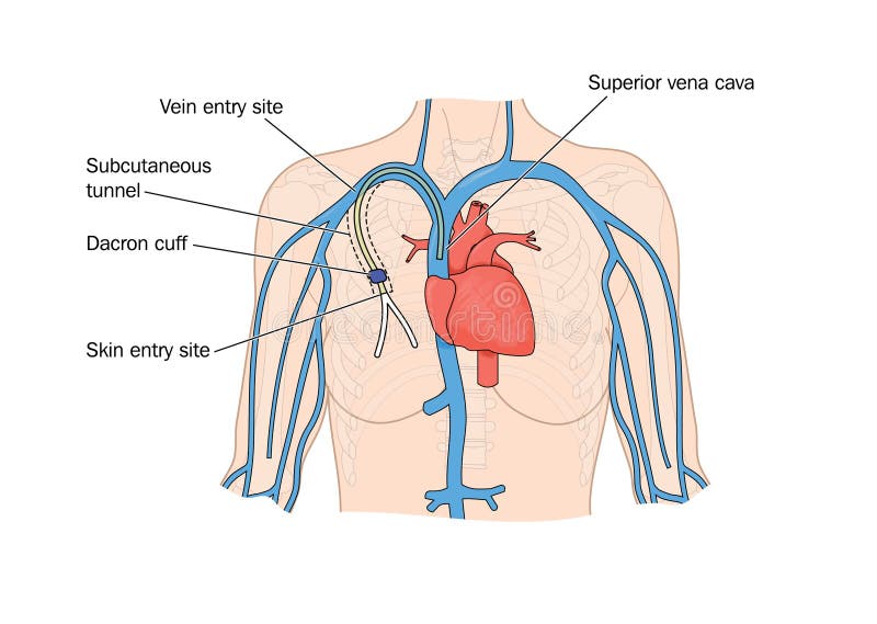 Catheterisatie Van Het Hart is Een Methode Die Wordt Gebruikt Om ...