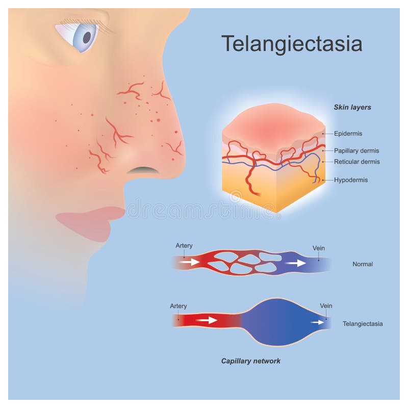 Telangiectasia. Problem Tiny Blood Vessels Widened or Formed Located ...