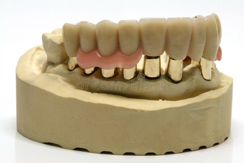 Telescopic prosthesis stock image. Image of dentistry - 50262149