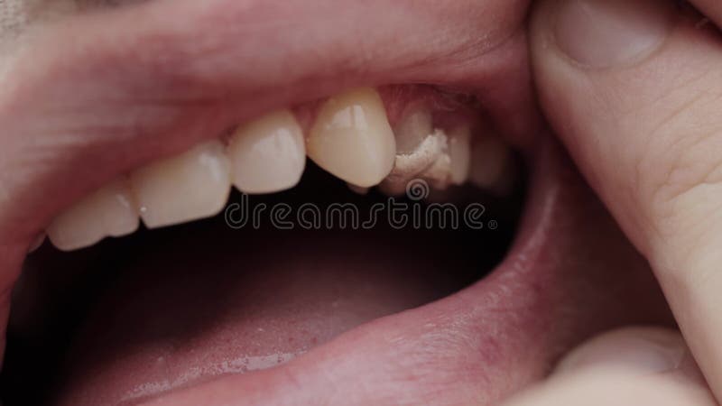 Temporary Fillings on Teeth after Pulpitis Treatment. Temporary ...