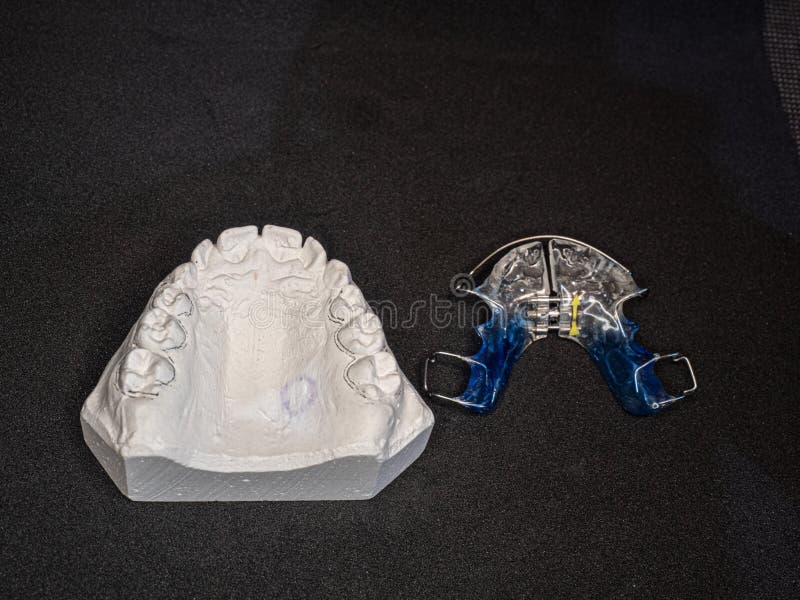 Temporary Retainers on White Plaster Cast Stock Image - Image of detail ...