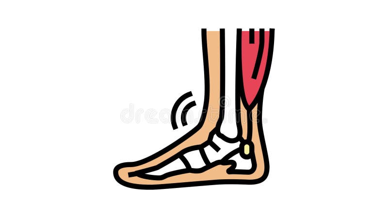 Ankylosing Spondylitis Stock Footage & Videos - 70 Stock Videos