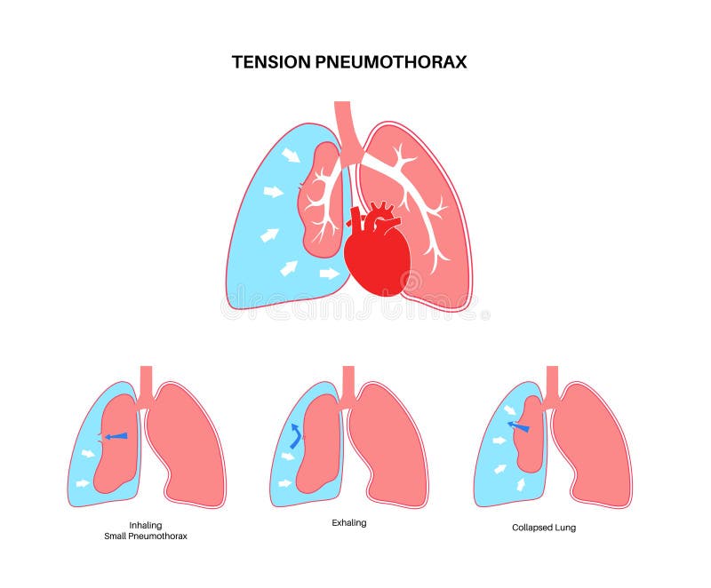 Pneumothorax Diagram Stock Illustrations – 103 Pneumothorax Diagram ...