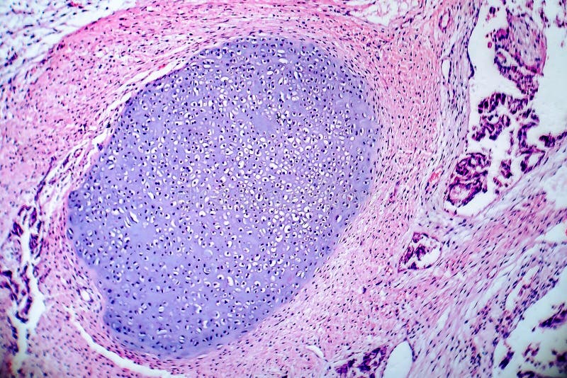 Types Cancer Found Nerve Cell Stock Photos - Free & Royalty-Free Stock ...