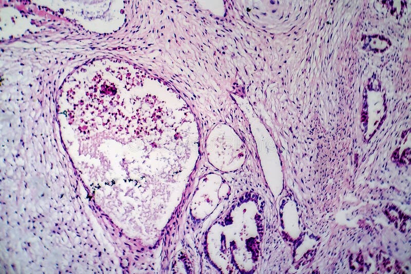 Types Cancer Found Nerve Cell Stock Photos - Free & Royalty-Free Stock ...