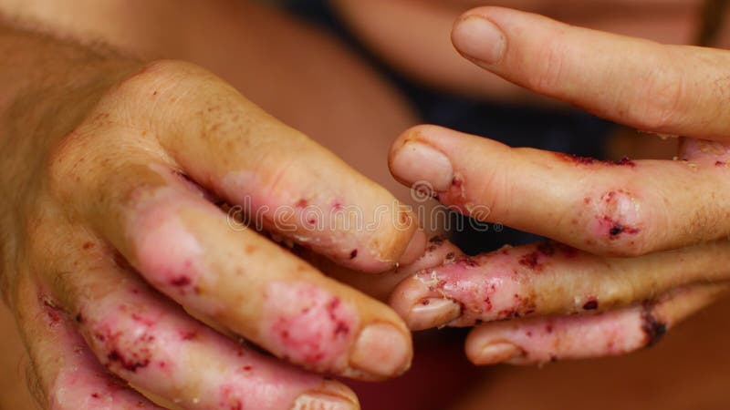 Terrible Ulcers on the Hands, Illness Stock Footage - Video of eczema ...