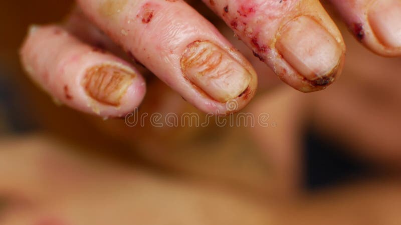 Terrible Ulcers on the Hands, Illness Stock Video - Video of body ...