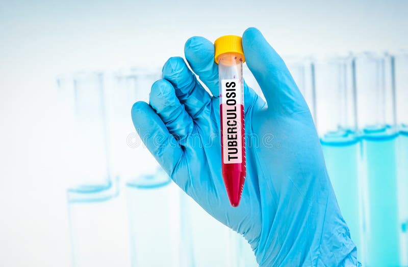 Test-tube with Blood Sample for TUBERCULOSIS Test Stock Photo - Image ...