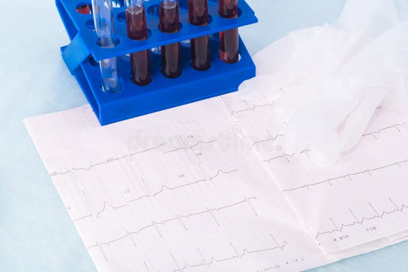 Test Tubes with Blood Tests on a Light Table with the Results of an ECG ...