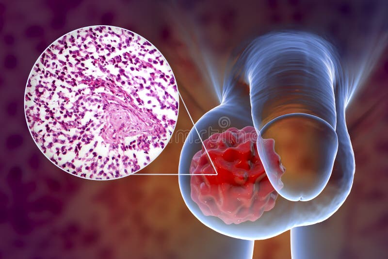 Testicular Cancer 3d Illustration And Light Micrograph Stock