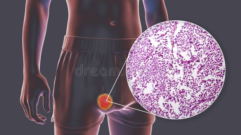 Testicular Cancer 3d Illustration Stock Illustration Illustration Of