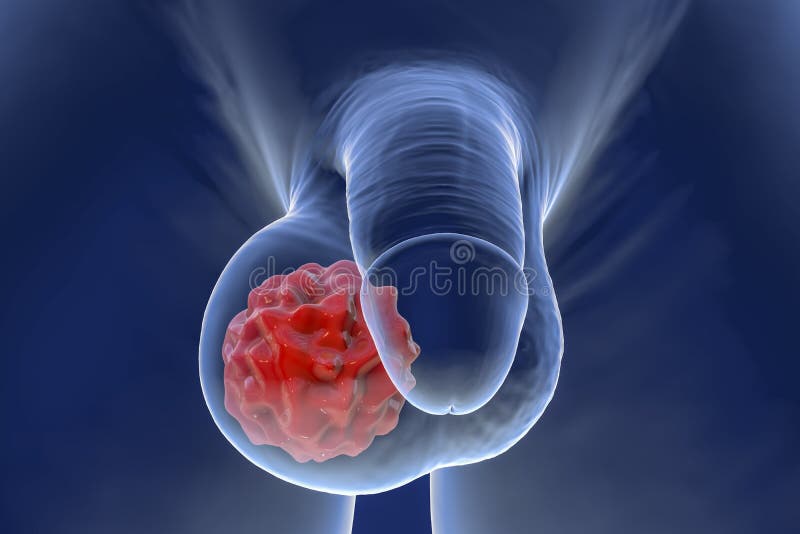 Testicular Cancer 3d Illustration Stock Illustration Illustration Of
