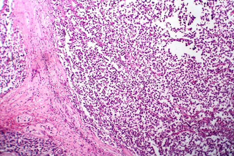 Testicular Seminoma, Light Micrograph Stock Photo - Image of ...