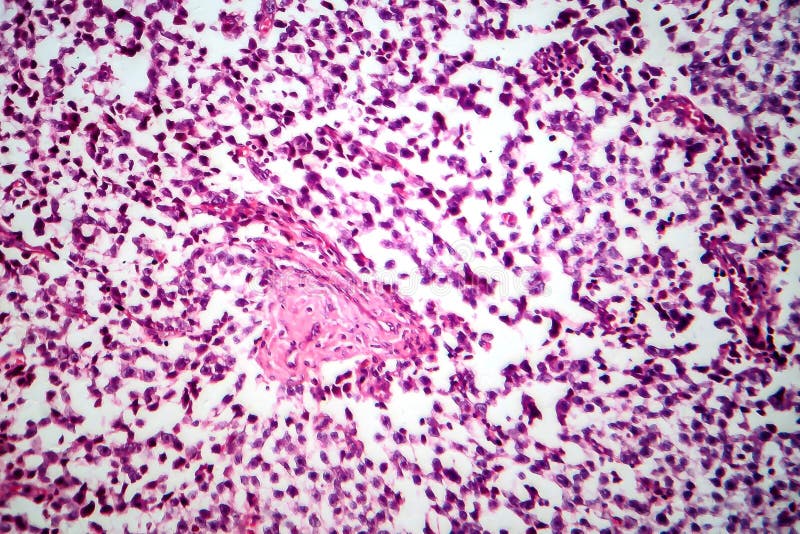 Testicular Seminoma, Light Micrograph Stock Image - Image of morphology ...