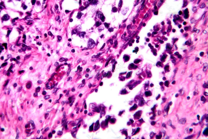 Testicular Seminoma, Light Micrograph Stock Photo - Image of disease ...