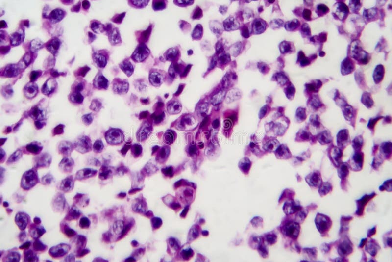 Testicular Seminoma, Light Micrograph Stock Image - Image of ...