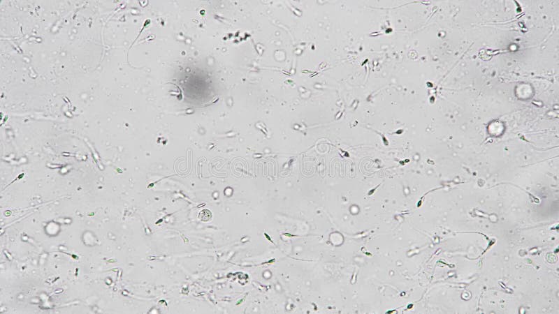 Sperm from the Semen of a Middle-aged Man Under a Microscope ...