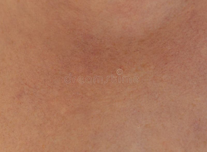 Texture De Peau Avec Le Rosacea Et Le Couperose Image stock - Image du ...