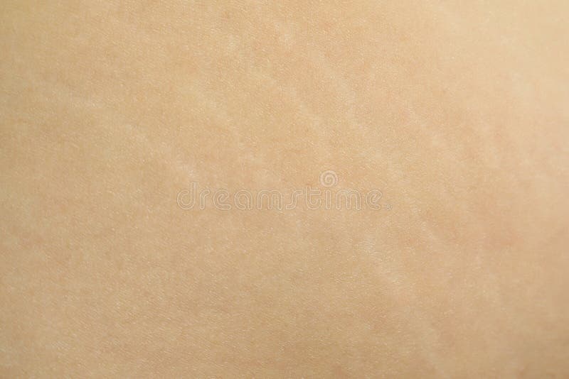 Texture of Human Skin with Birthmark and Stretch Marks, Closeup View ...