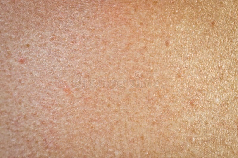 Freckled human skin stock image. Image of spotty, detail - 2579925