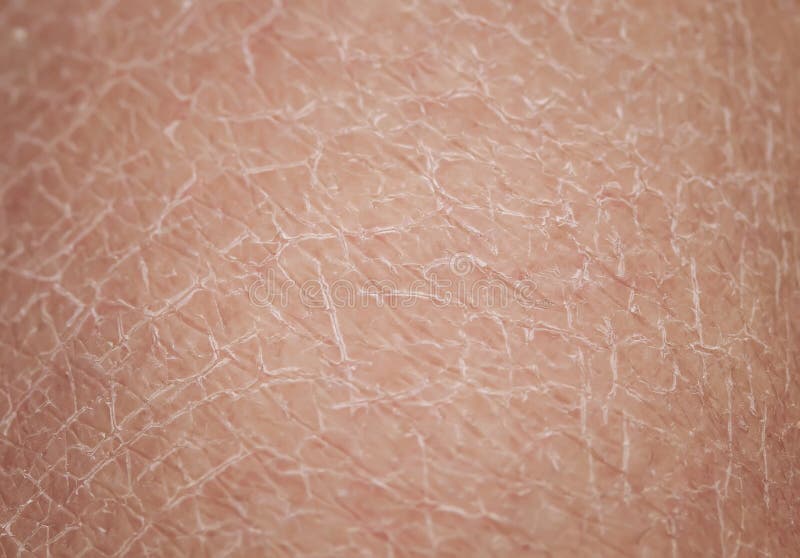 Texture of Human Skin Large with Dermatological Problems of Dryness and ...