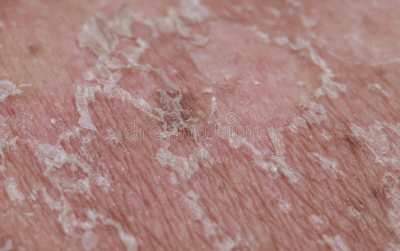 Texture of Problematic Human Skin Close Up with Pigmentation and ...