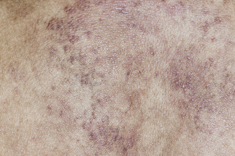 Texture Red Rash on Back Man Stock Image - Image of contagious, rear ...