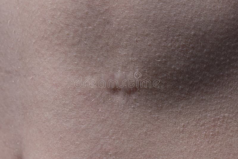 Texture of Man`s Skin with the Scar Burn, Closeup Photo Stock Photo ...