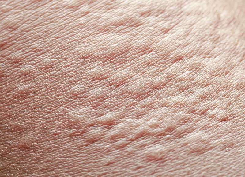 Texture Of Irritated Reddened Skin With Flaking Scales Of Dead Old