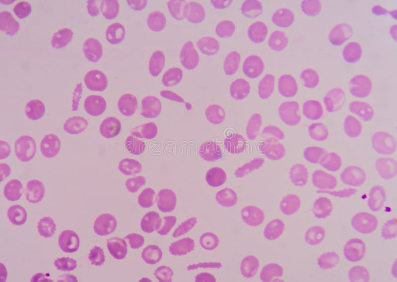 Morphologie Anormale De Globules Rouges De Calomnie De Sang De ...