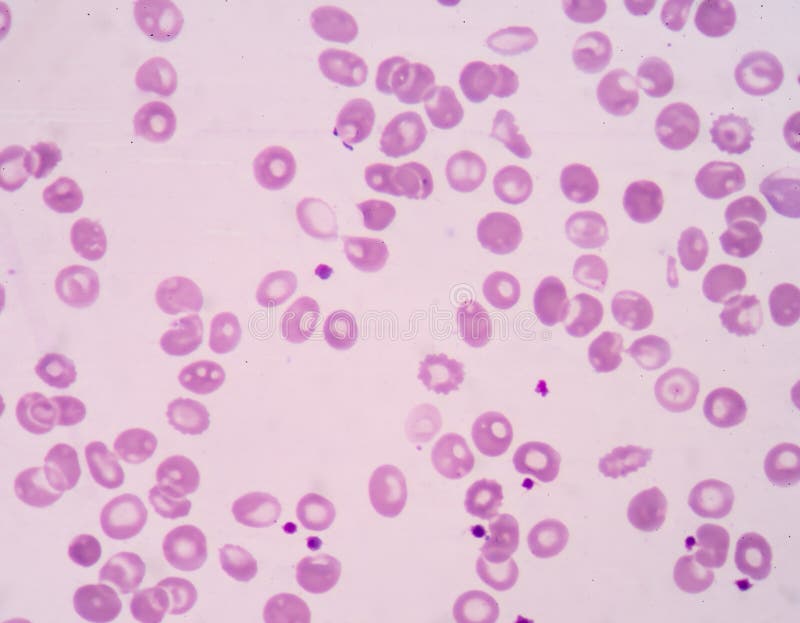 Thalassemia Blood Smear Abnormal Red Blood Cells Morphology. Stock ...