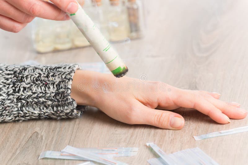 Therapist Doing Moxa Treatment Stock Photo - Image of moxibustion ...