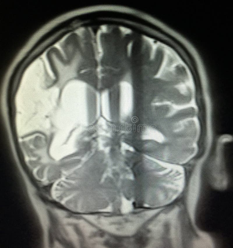 Acute Infarction Brain Mri Examination Stroke Stock Image - Image of ... Acute Infarction Brain Mri Examination Stroke Stock Image - Image of ...