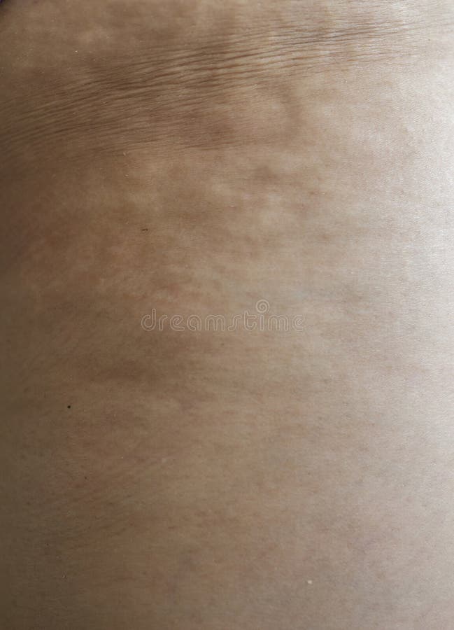 There is a Problem with the Skin Texture of Women Stock Photo - Image ...