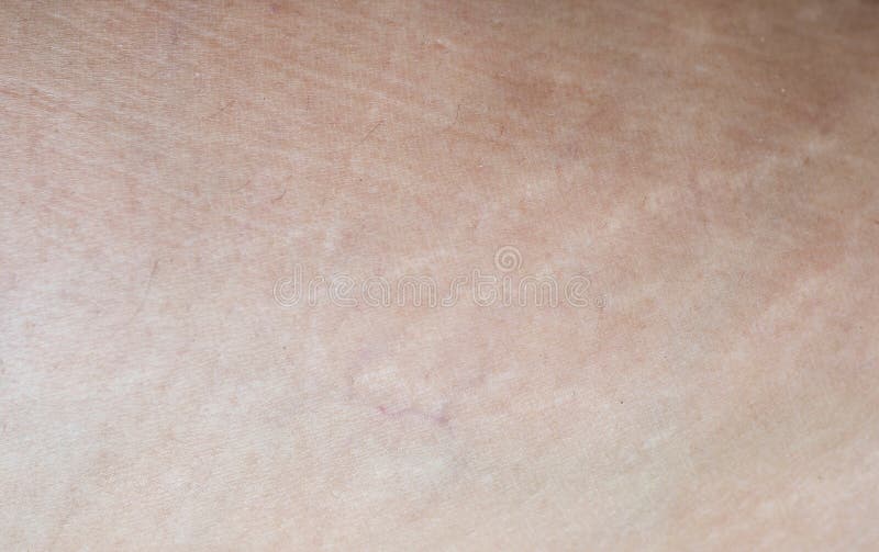 There is a Problem with the Skin Texture of Women Stock Photo - Image ...