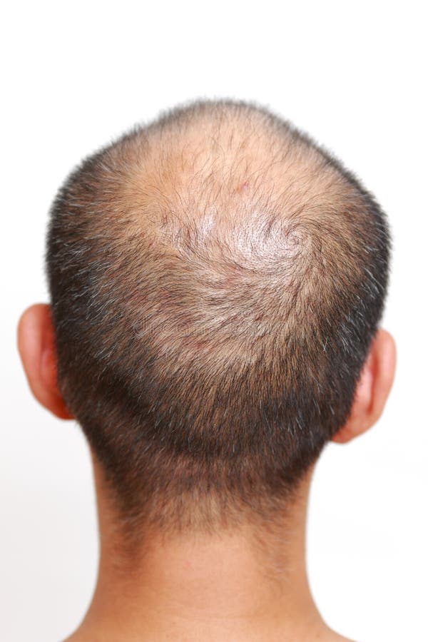 Thin hair stock photo. Image of stubble, thin, scalp - 43796566