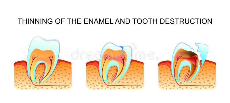 Tooth Destruction Stages stock illustration. Illustration of health ...