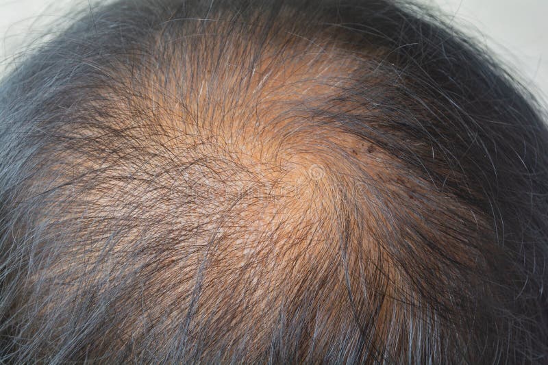 Thinning Hair in Women Scalp Problems Stock Image - Image of beauty ...