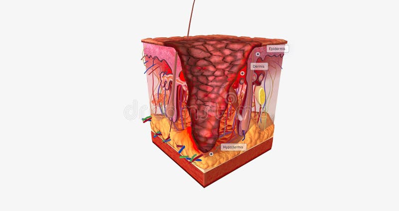 A Third Degree Burn Will Damage All of the Layers of the Skin: the ...