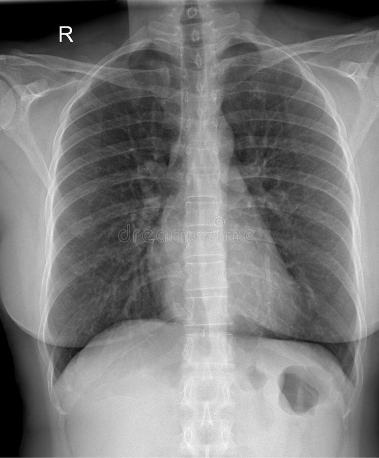 Thoracic Cavity X-Ray: Diagnosing Heart, Lung, and Ribcage Issues Stock ...